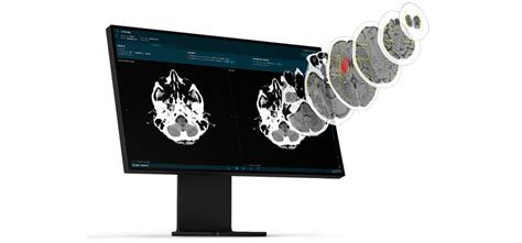 Brainomix Partners With Medtronic To Expand Its Ai Powered Stroke