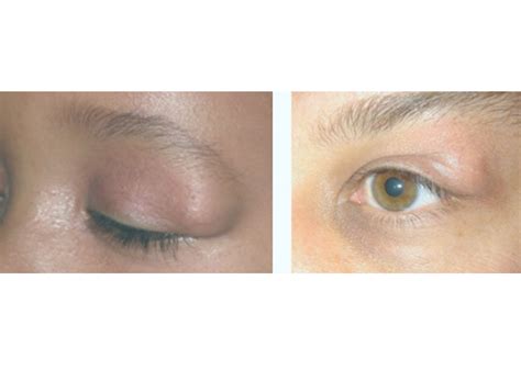 Congenital Dermoid The Dh Verity Eye Practice