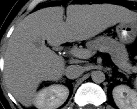 Liver Atlas Diagnosis Cholangiocarcinoma