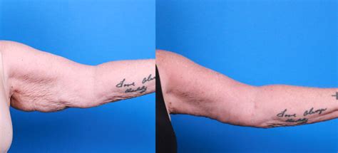 Brachioplasty Before And Afters Plastic Surgery Center Of Hampton Roads