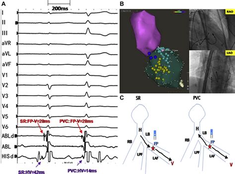 Catheter Ablation Of Premature Ventricular Complexes Arising From The