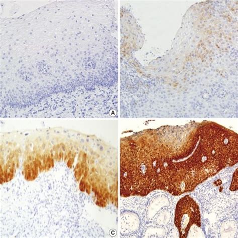 The Cases Interpreted As Cervical Intraepithelial Neoplasm Cin 2 By