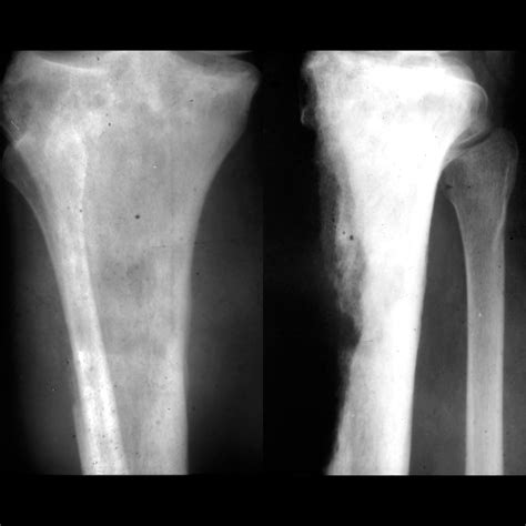 Fibrosarcoma X Ray