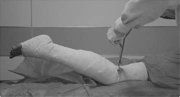 Postoperative Photographs Showing The Serial Casting From The Thigh To