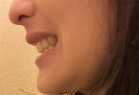 Before And After Premolar Extractions R Braces