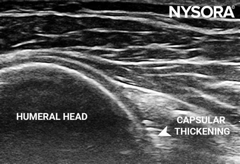 Adhesive Capsulitis Release Protocol At Jackie Proctor Blog