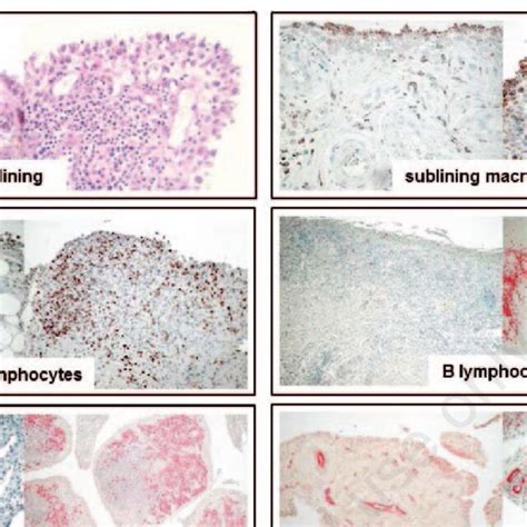 Synovial Tissue Heterogeneity Inter Individual Variations Of Synovial