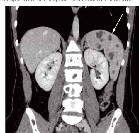 Figure 1 From Two Rare Cases Of Cystic Angiomatosis And A Literature Review Semantic Scholar