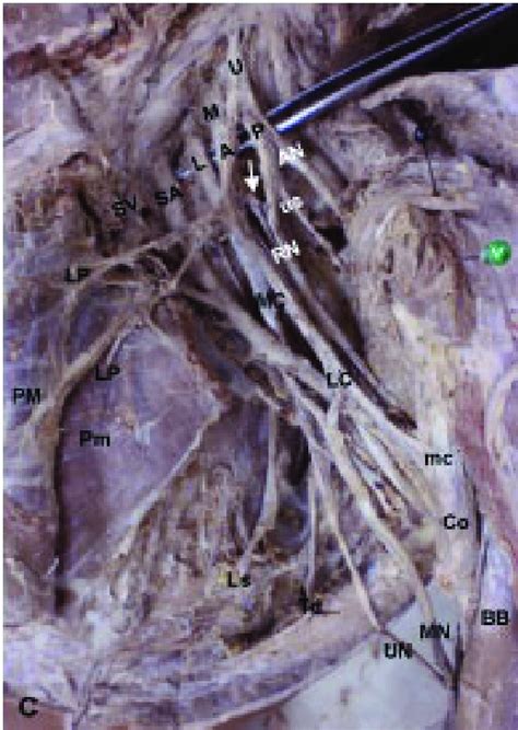 C A Photograph Of The Left Axilla Of The Previous Specimen Showing