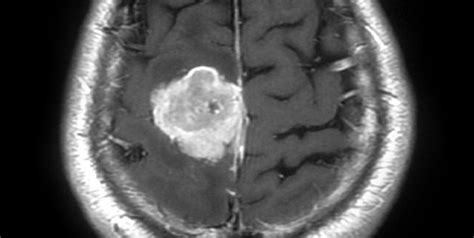 Brain Tumor Mri Images 44 Classes Kaggle