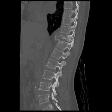 Tuberculous Spondylitis Pacs