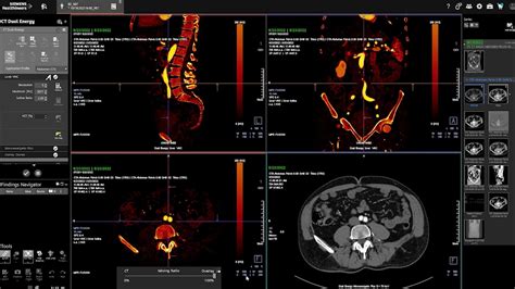 Pcct Scientific Evidence Siemens Healthineers
