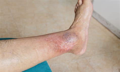 Venous Ulcers Uncovered What You Need To Know For Better Healing