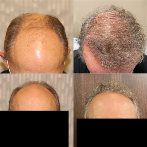 Norwood 7 Hair Restoration 59 Year Old 3700 Grafts