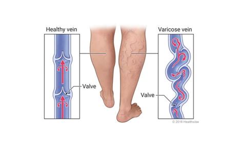 Varicosities Diagram