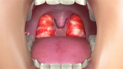 Tonsil Andor Adenoid Problems