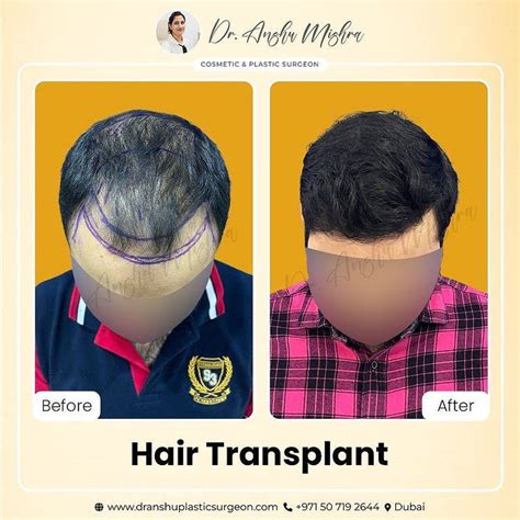 Labiaplasty Surgery In Dubai Dr Anshu Mishra