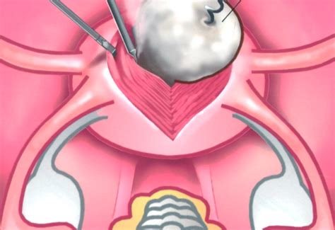 Single Incision Laparoscopy Landmark Cases Anthony Siow
