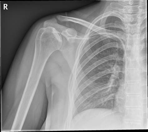 What Causes Avascular Necrosis Of Humeral Head At Hattie Keyes Blog