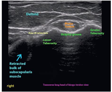 Ultrasound Guided Injection Technique For Subscapularis Tendonitis Anesthesia Key