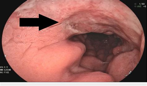 Endoscopic View Of Infiltrative Ulcerated Mass In Prepyloric Region And