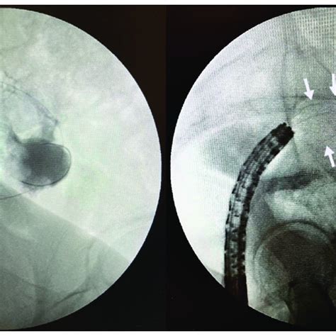 A 54 Year Old Woman With Distal Sigmoid Obstruction Due To Obstructing