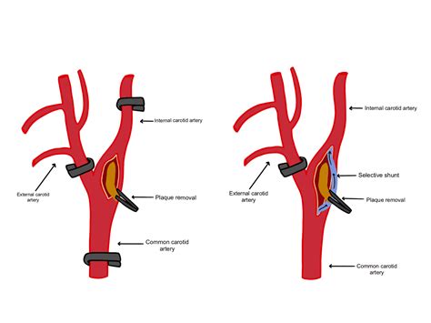 What Is Aortic Cross Clamp At Michael Theis Blog