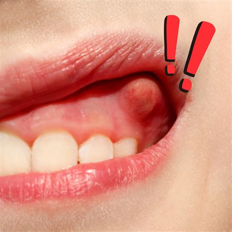 Neo Lumps Bumps And Patches In The Mouth Are All Signs Of Serious