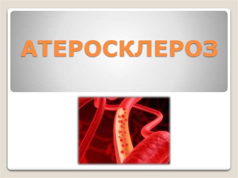 Атеросклероз. Лечение - презентация онлайн
