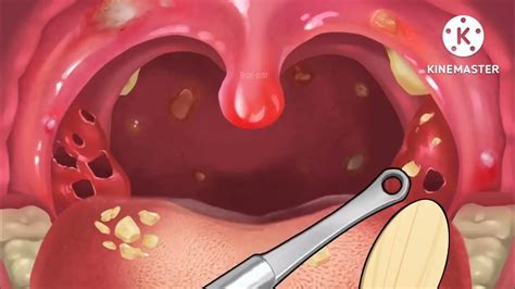 Girlfriend Break Up Cause Of Bad Breath Mouth Ulcers Tonsil Tongue