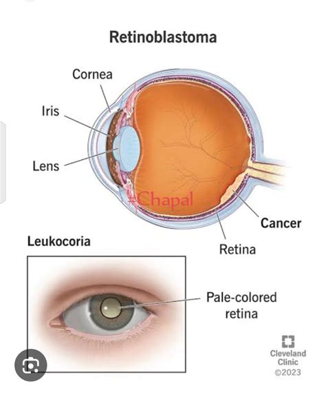 ♥️ ♥️ Retinoblastoma Dr Tajmilur Rahman Chapal Facebook