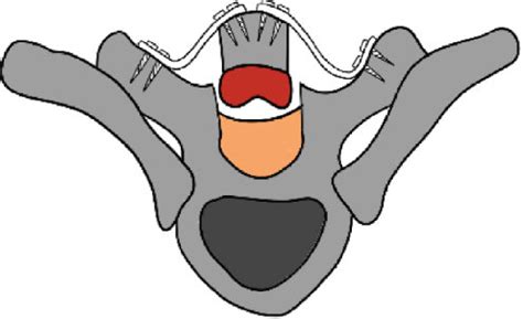 Illustration Of The Procedures Of Thoracic Extensive Laminoplasty