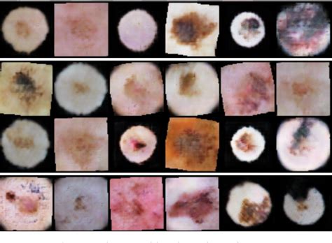 Figure From An Optimal Method For Melanoma Detection From Dermoscopy Images Using