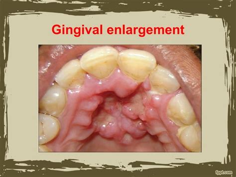 Oral Manifestation Of Tuberculosis Ppt