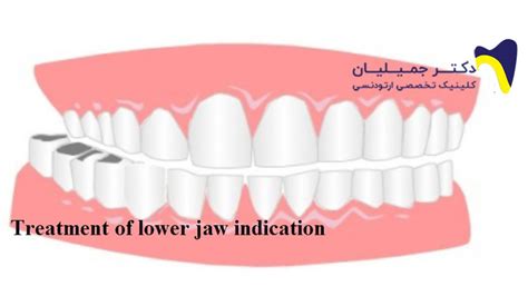 Treatment Of Mandibular Deviation Dr Jamilian