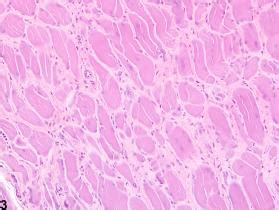 Skeletal Muscle Fibrosis Nonneoplastic Lesion Atlas