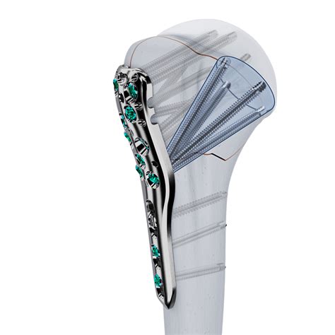 Volt Proximal Humerus Plating System