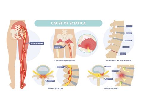 Tulane Doctors Orthopaedics Sciatica Tulane School Of Medicine