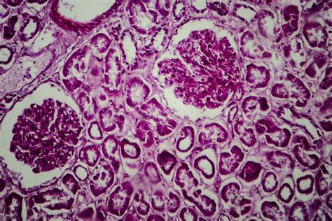Diffuse Sclerosing Glomerulonephritis Stock Image Image Of Microscopy