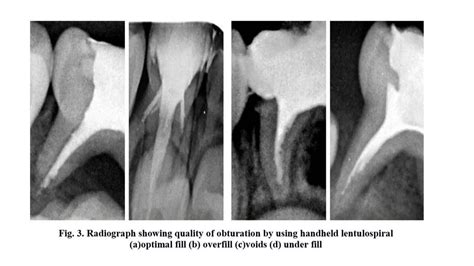 Obturation Techniques In Primary Teeth Pptx Dental Health