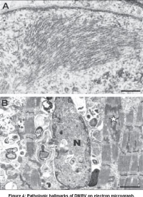 Figure 4 From Distal Myopathies A Review Highlights On Distal Myopathies With Rimmed Vacuoles