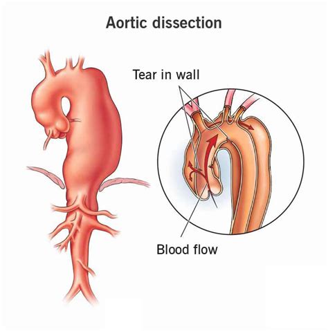 Aortic Dissection Symptoms And Treatment Wockr