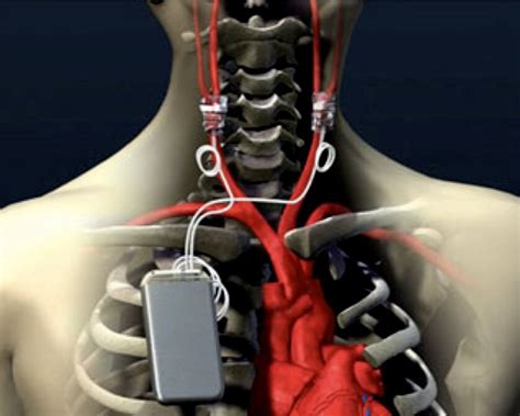 Neuromodulation Device — Lucid Labs Product Design And Development