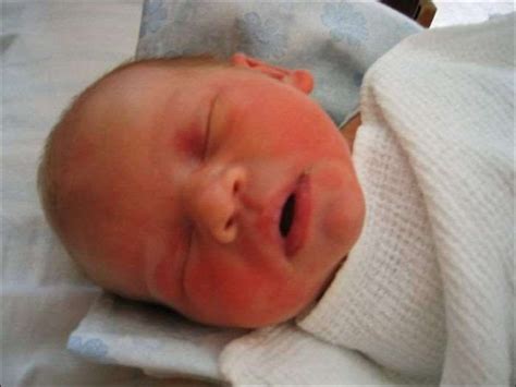 Захворювання новонароджених дітей Захворювання шкіри пупкової ранки сепсис презентация онлайн