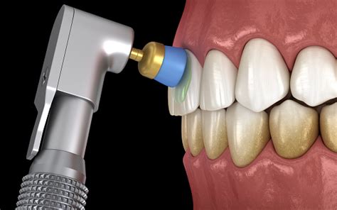 치아 연마 전문 브러시와 젤 절차입니다 의학적으로 정확한 3d 그림 검사 보기에 대한 스톡 사진 및 기타 이미지 검사 보기 디지털 생성 이미지 반짝이는 Istock