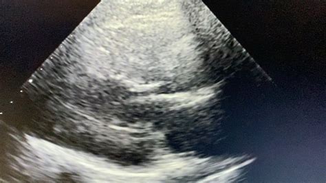 Hendre Van Rensburg No Linkedin Echocardiography Echo