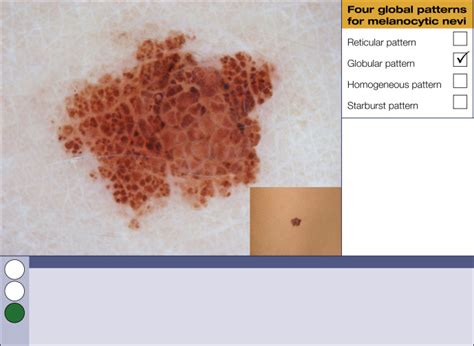 Pattern Analysis Dermoscopic Criteria For Specific Diagnoses Plastic
