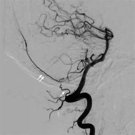 Posterior Meningeal Artery Ars Neurochirurgica