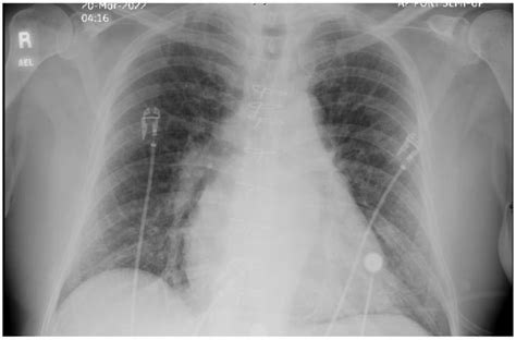 Prominent Cardiac Silhouette Status Post Median Sternotomy Download Scientific Diagram