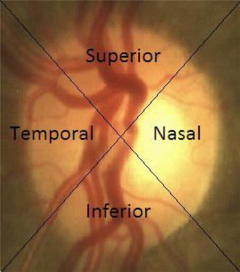 Figure 1 From Detection Of Glucoma Using Decision Tree Semantic Scholar